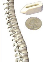 Ollif Procedure Minneapolis